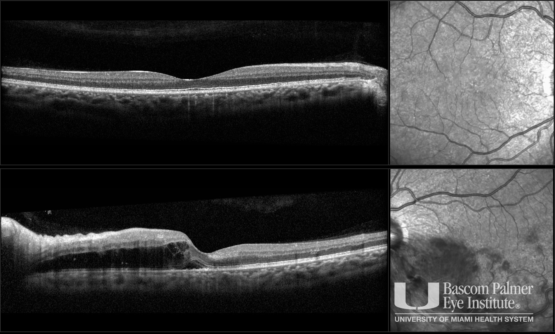Course: Caffeine-Associated Hemi-Retinal Vein Occlusion of the Left Eye secondary Cystoid ...